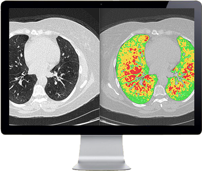 Lung Density Analysis™- Functional - Imbio